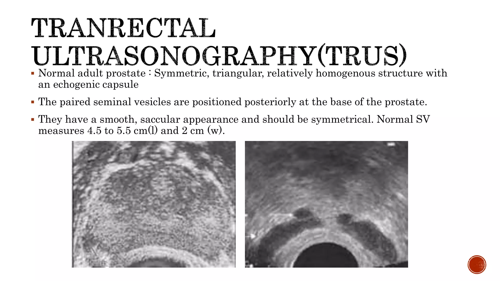 Carcinoma of prostate | PPTX