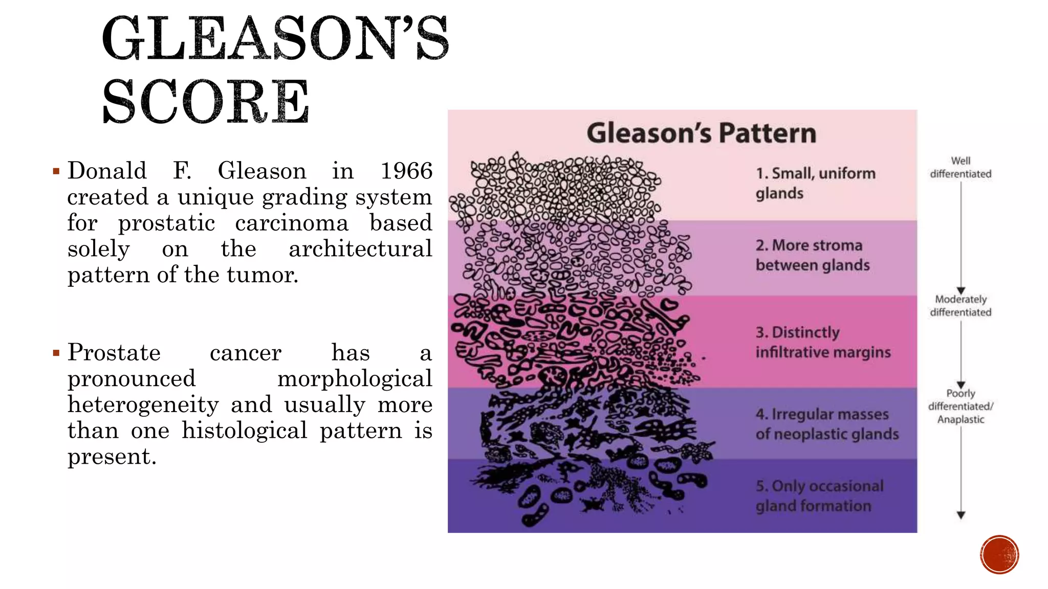 Carcinoma of prostate | PPTX