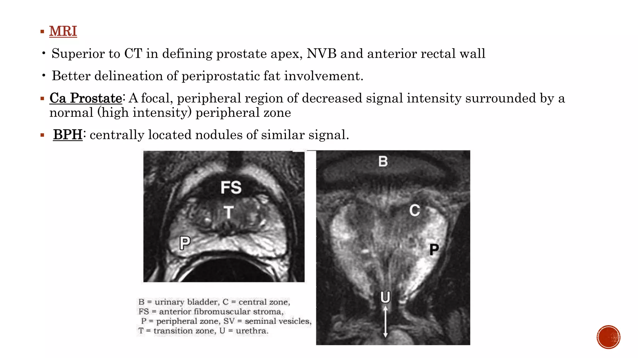 Carcinoma of prostate | PPTX
