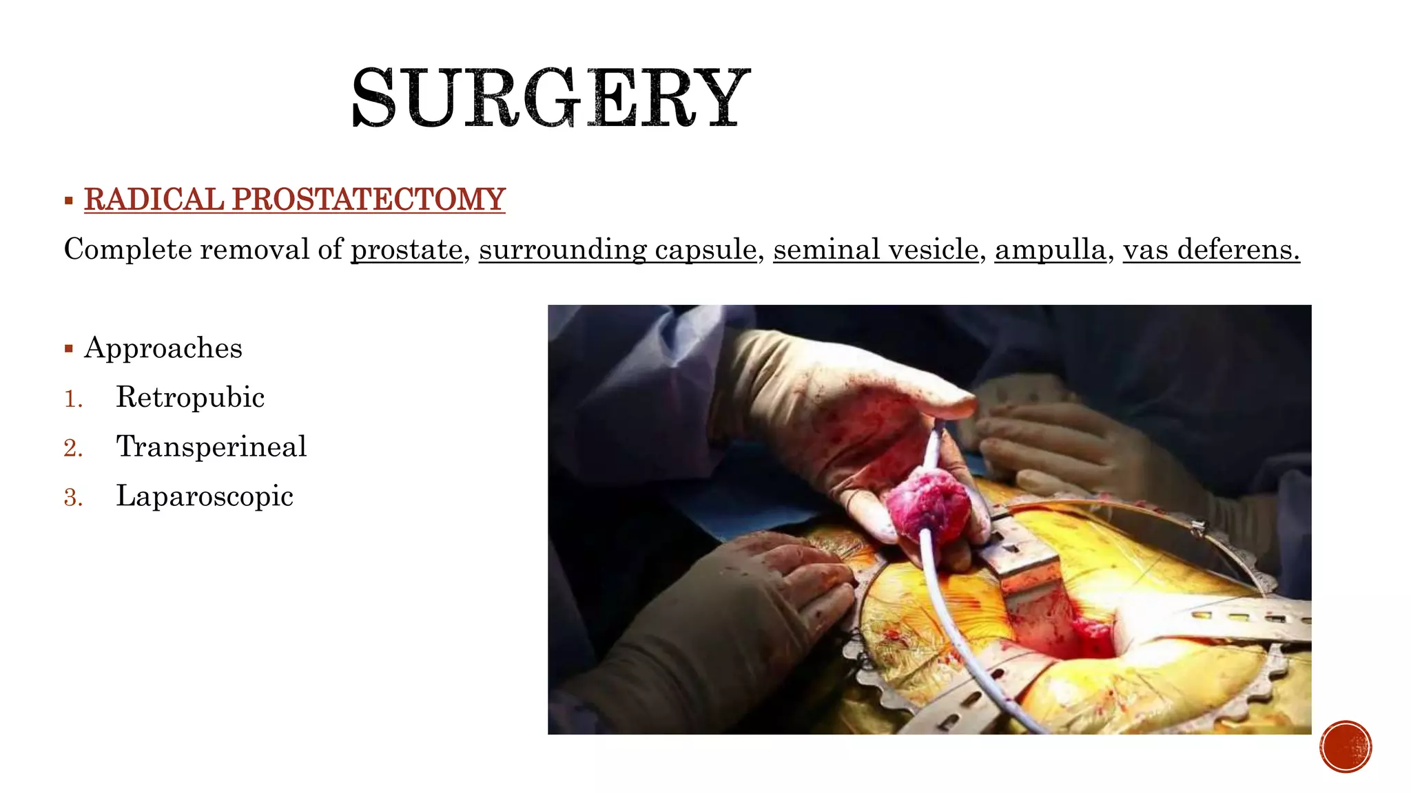 Carcinoma of prostate | PPTX
