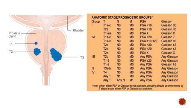 Carcinoma of prostate | PPTX | Reproductive Health | Diseases and ...