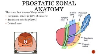 Carcinoma of prostate | PPTX