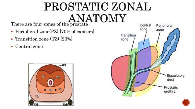 Carcinoma of prostate | PPTX | Reproductive Health | Diseases and ...