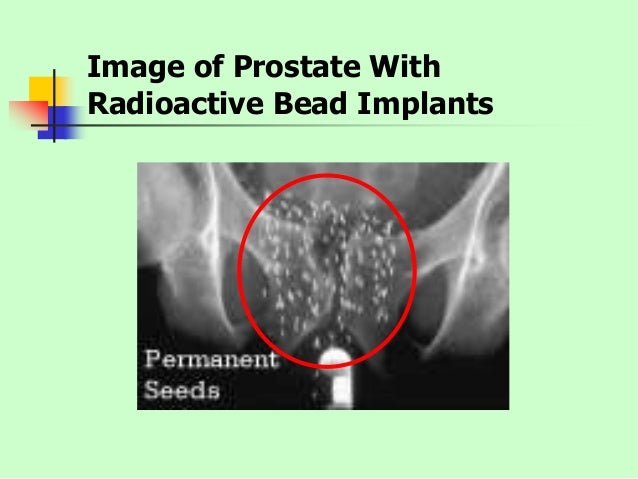 Ca prostate
