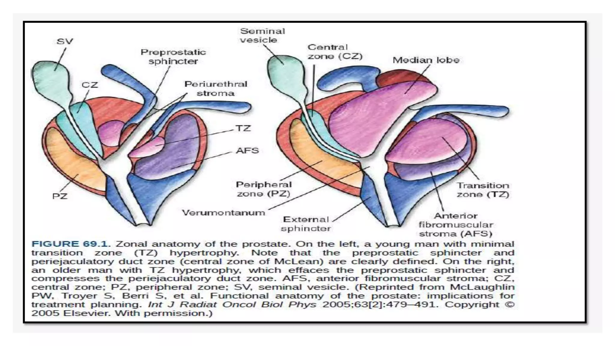 ca prostate by Dr. Musaib Mushtaq.ppt