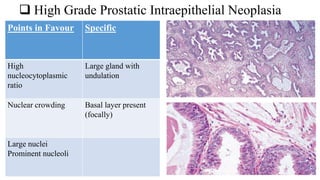 Ca Prostate Case discussion.presentation | PPTX