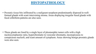 Ca Prostate Case discussion.presentation | PPTX