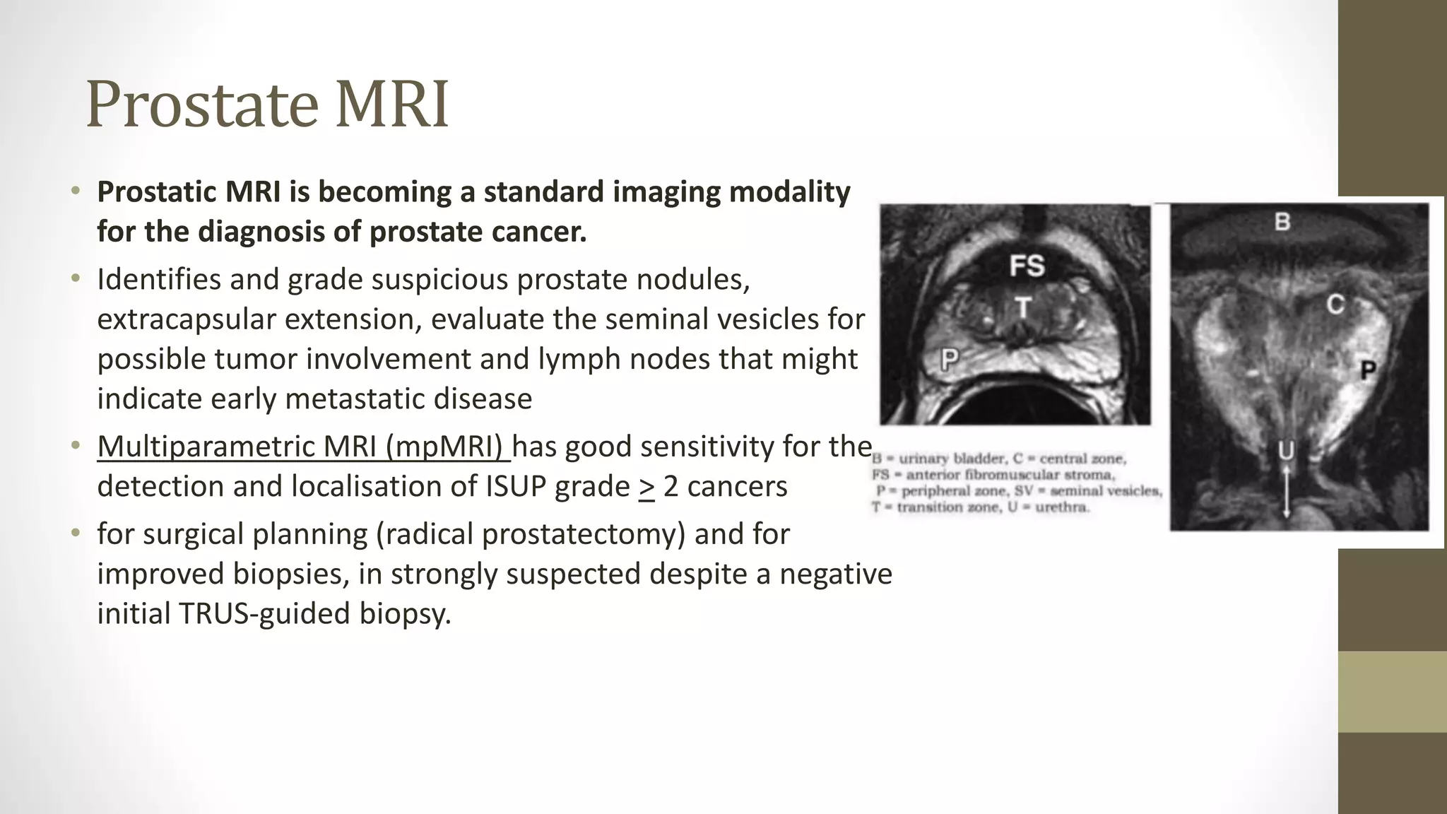 Carcinoma Of Prostate and its management | PPTX