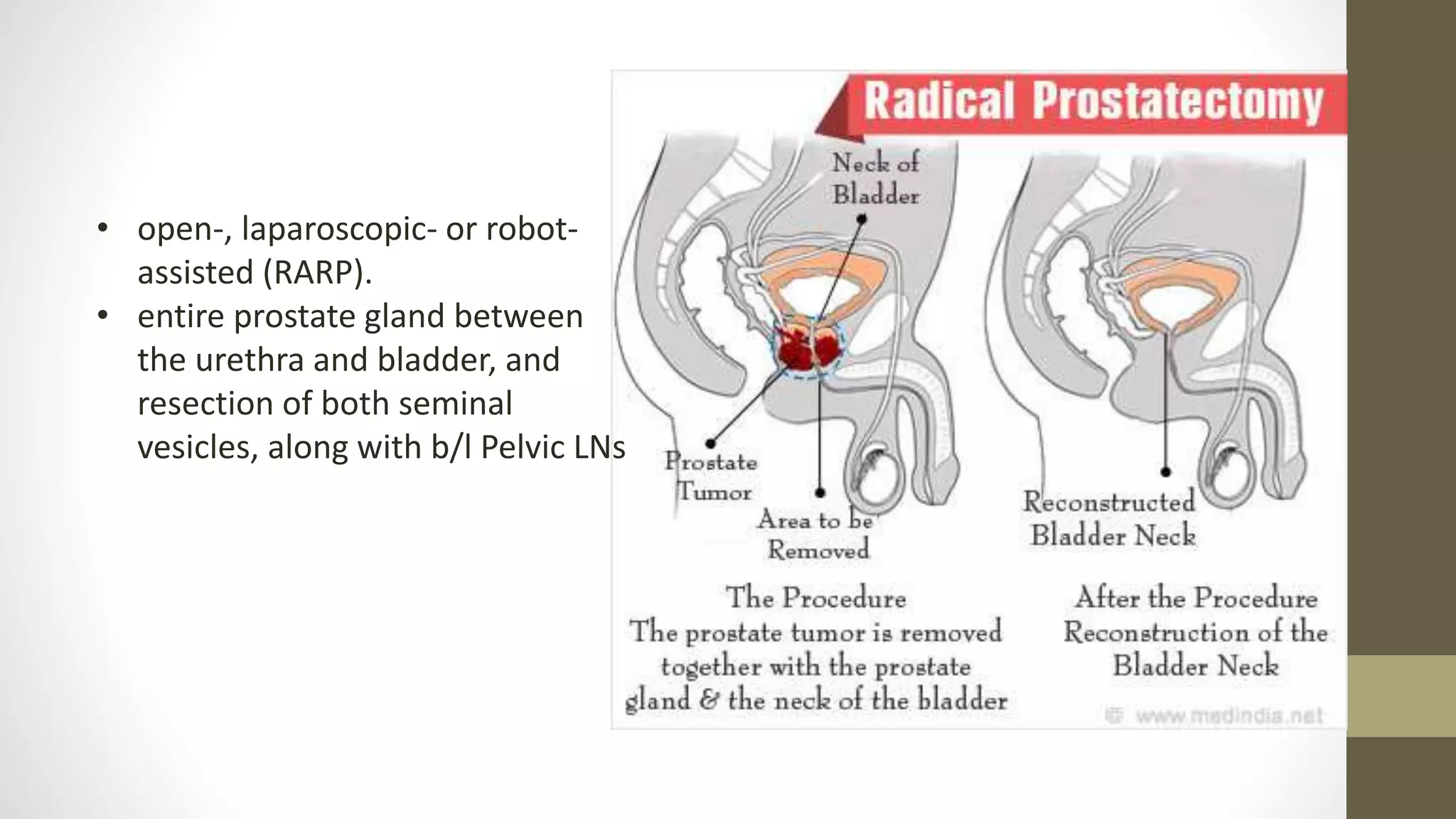 Carcinoma Of Prostate And Its Management Ppt
