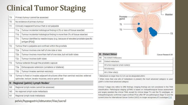 Carcinoma Of Prostate and its management | PPTX