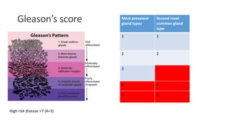 Ca Prostate MB6.pptx