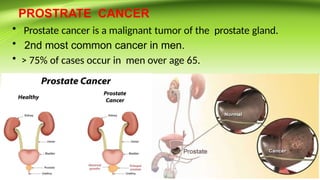Ca Prostrate.medical surgical nursingpptx | PPTX