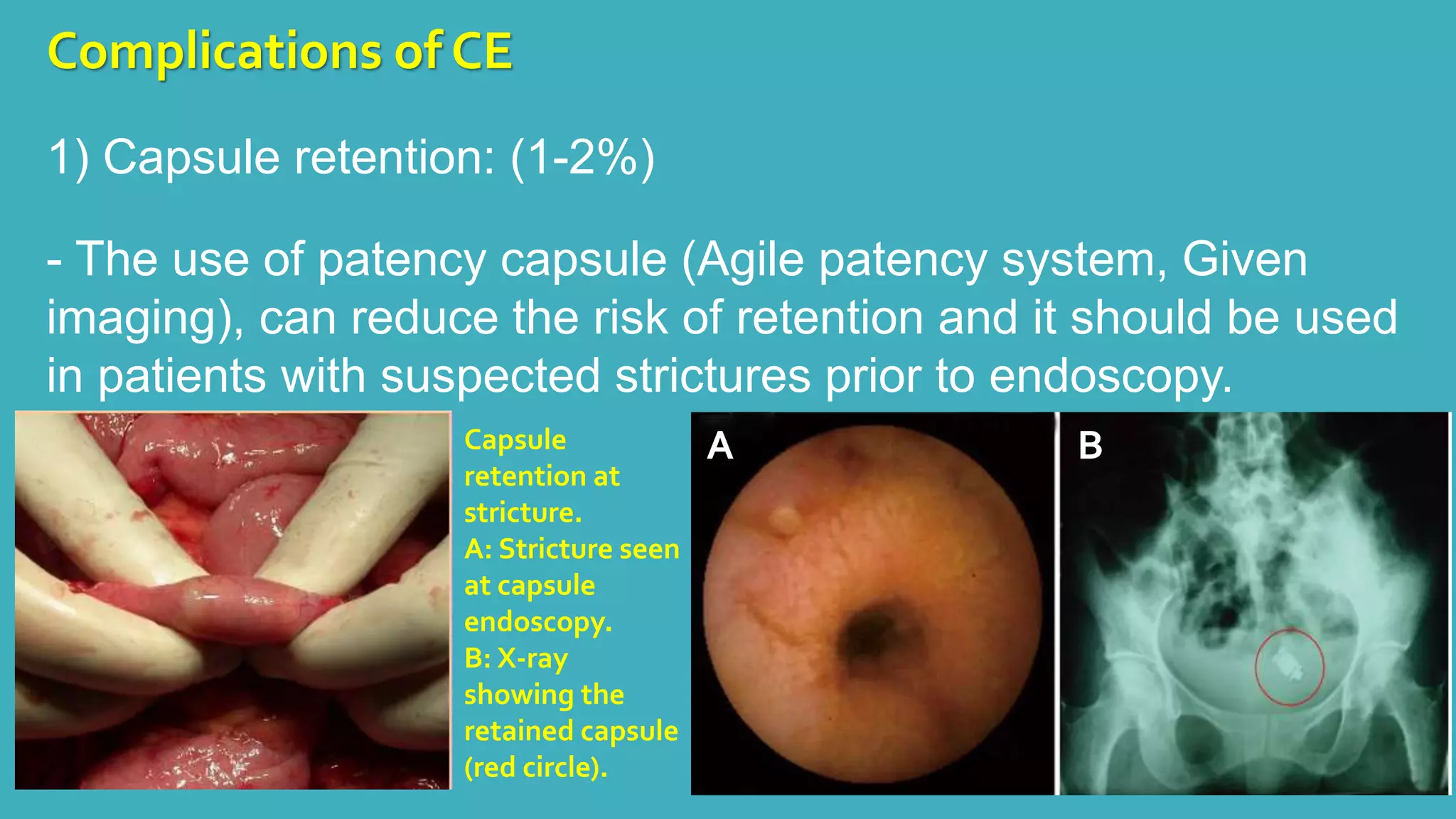 Capsule endoscopy | PPTX