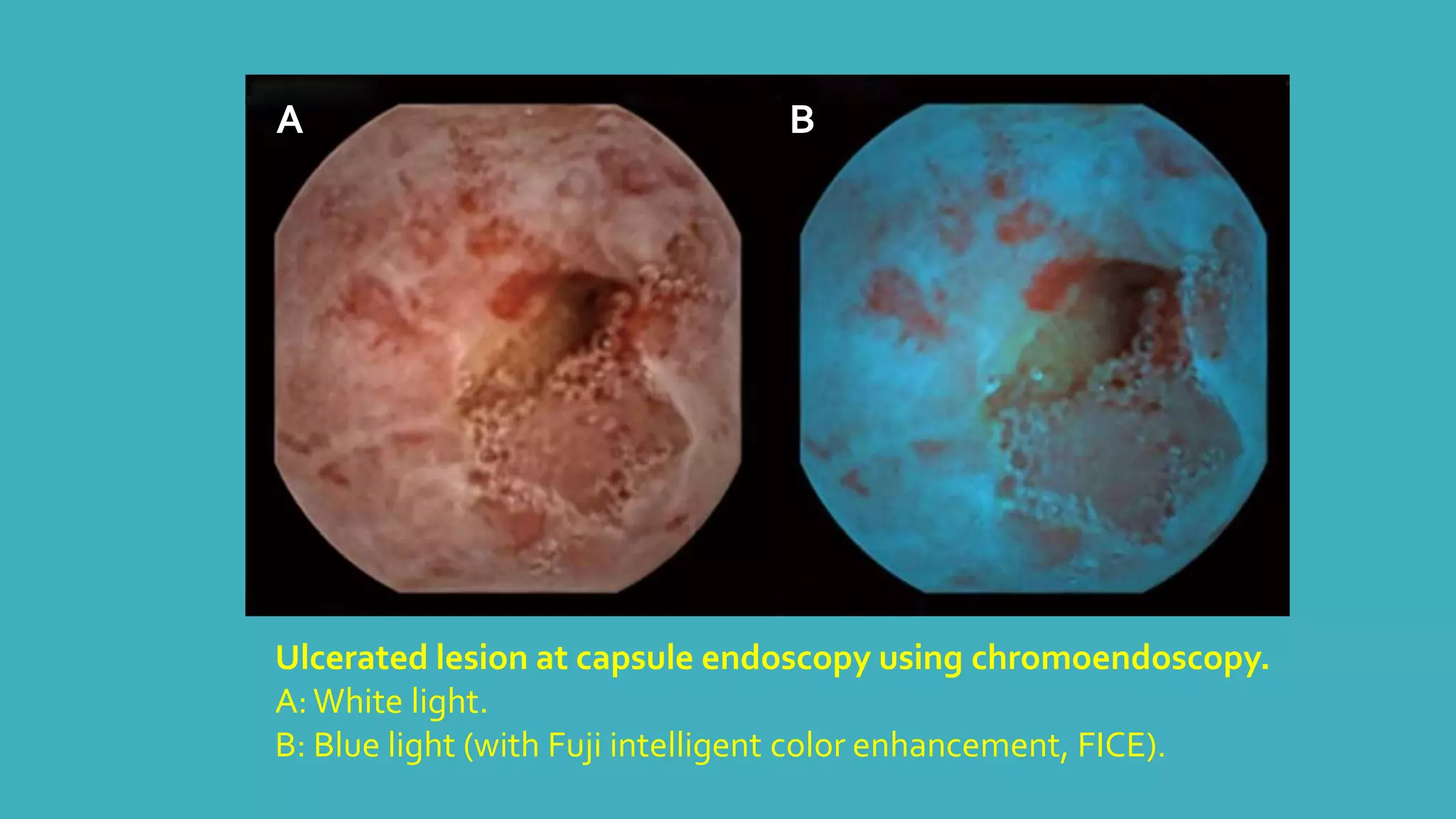 Capsule endoscopy | PPTX