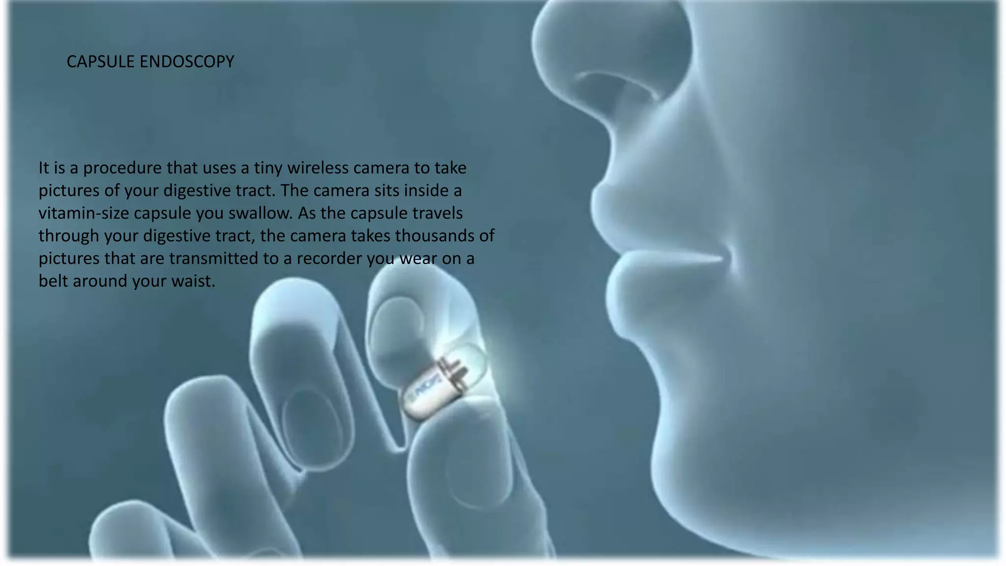 Capsule Endoscopy | PPT