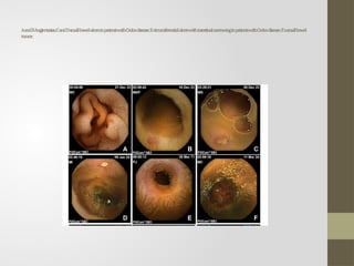 Capsule endoscopy of small bowel and it's diseases | PPTX