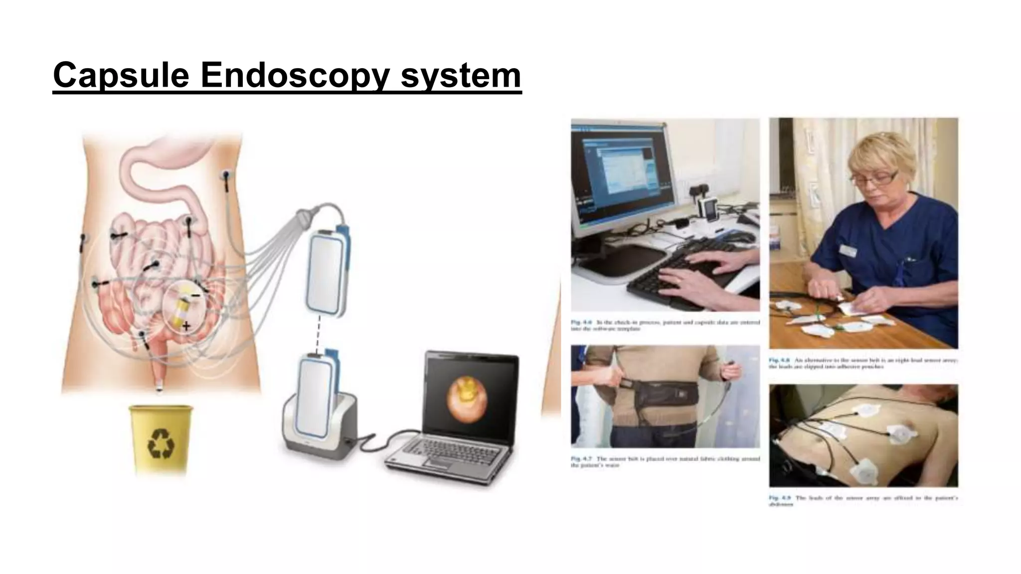 Capsule endoscopy_ A new dimension of endoscopy Final.pptx