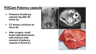 Capsule endoscopy_ A new dimension of endoscopy Final.pptx