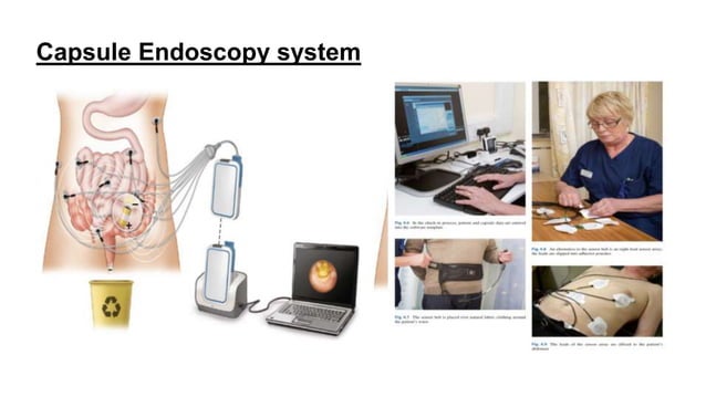 Capsule endoscopy_ A new dimension of endoscopy Final.pptx