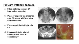 Capsule endoscopy_ A new dimension of endoscopy Final.pptx