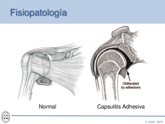 Capsulitis adhesiva en el hombro
