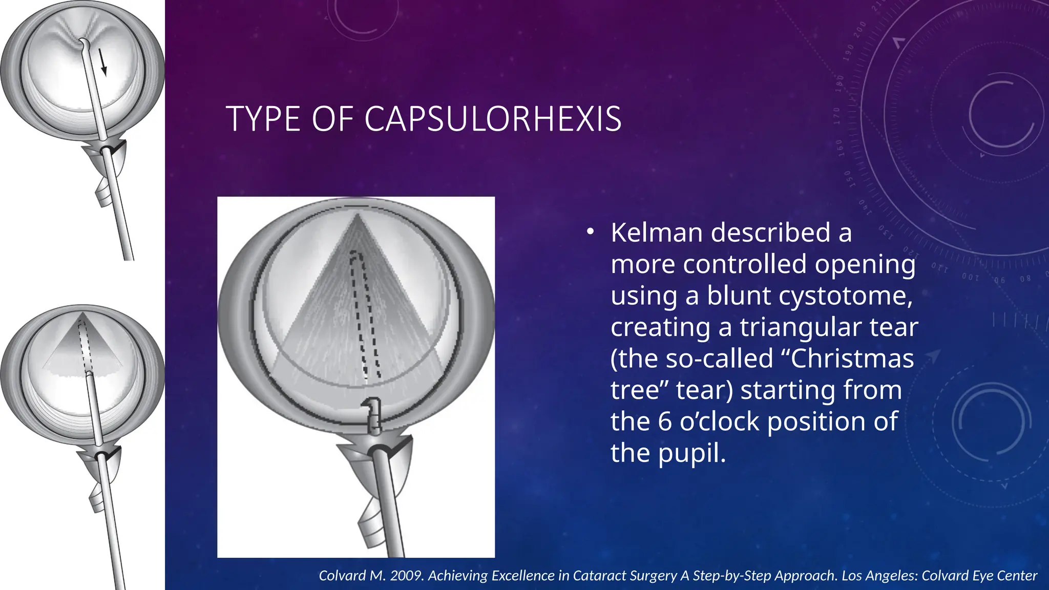 Capsulorhexis (jenis dan tatacara) pada operasi katarak.pptx