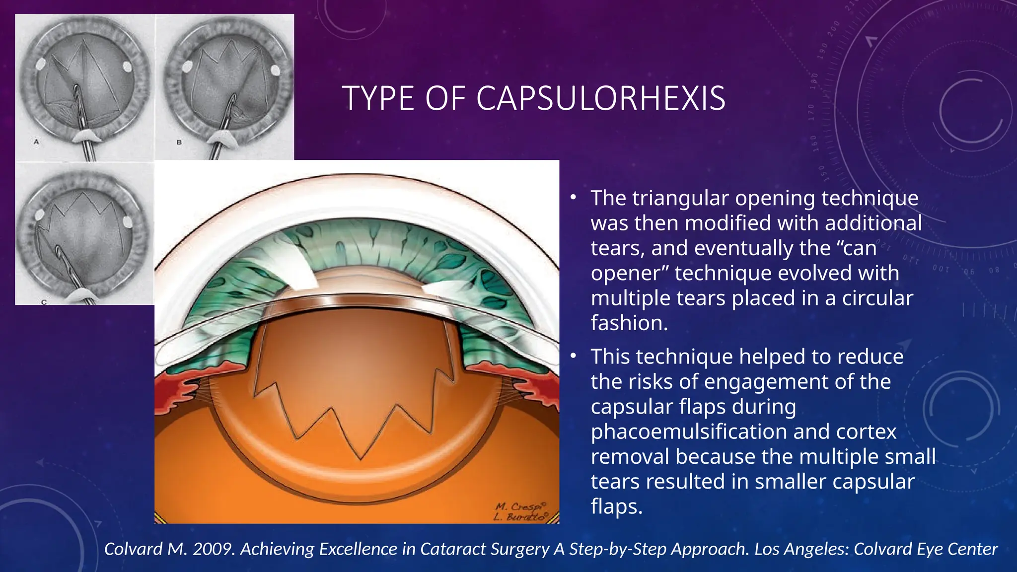 Capsulorhexis (jenis dan tatacara) pada operasi katarak.pptx