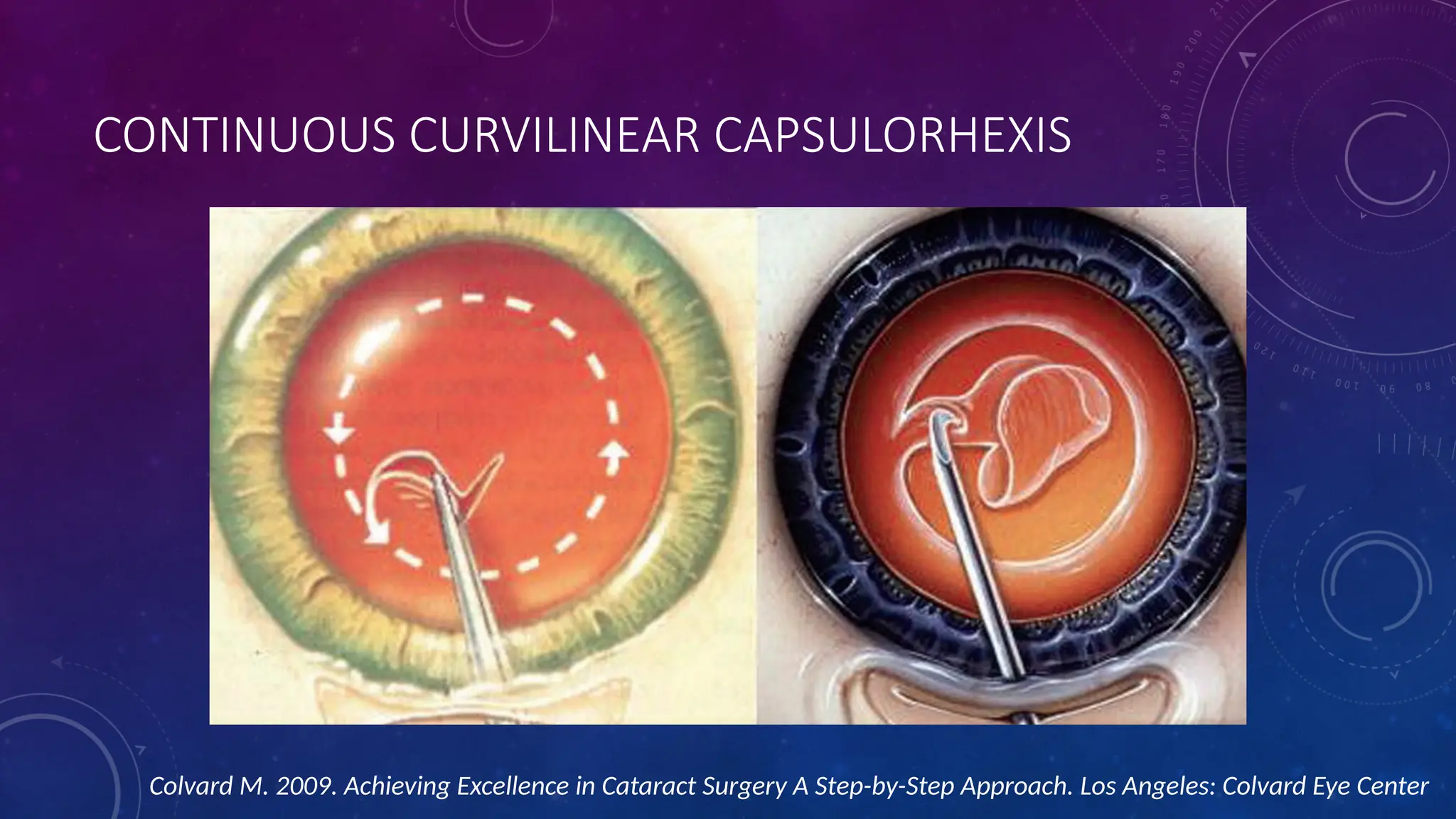 Capsulorhexis (jenis dan tatacara) pada operasi katarak.pptx