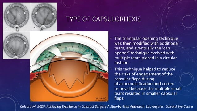 Capsulorhexis (jenis dan tatacara) pada operasi katarak.pptx