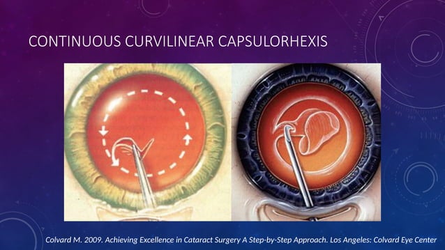 Capsulorhexis (jenis dan tatacara) pada operasi katarak.pptx