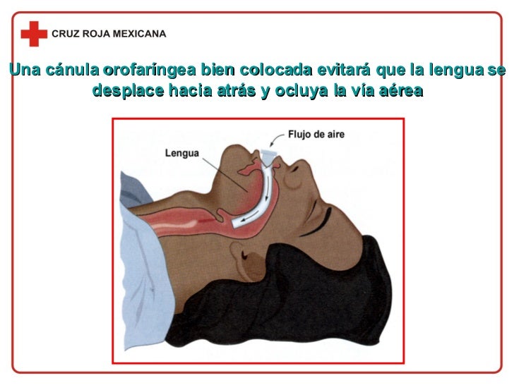 CapíTulo 07 Manejo BáSico De La VíA AéRea 2
