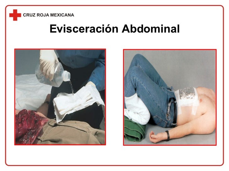 CapíTulo 15 Lesiones De Tejidos Blandos