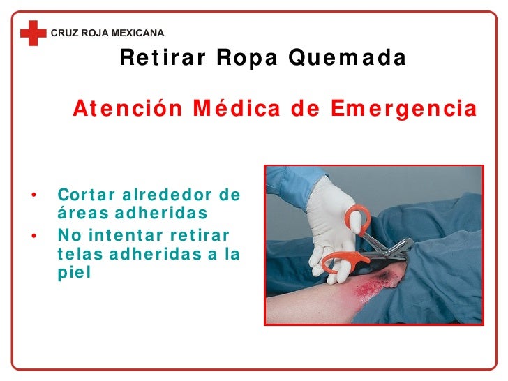 CapíTulo 16 Emergencias Por Quemaduras