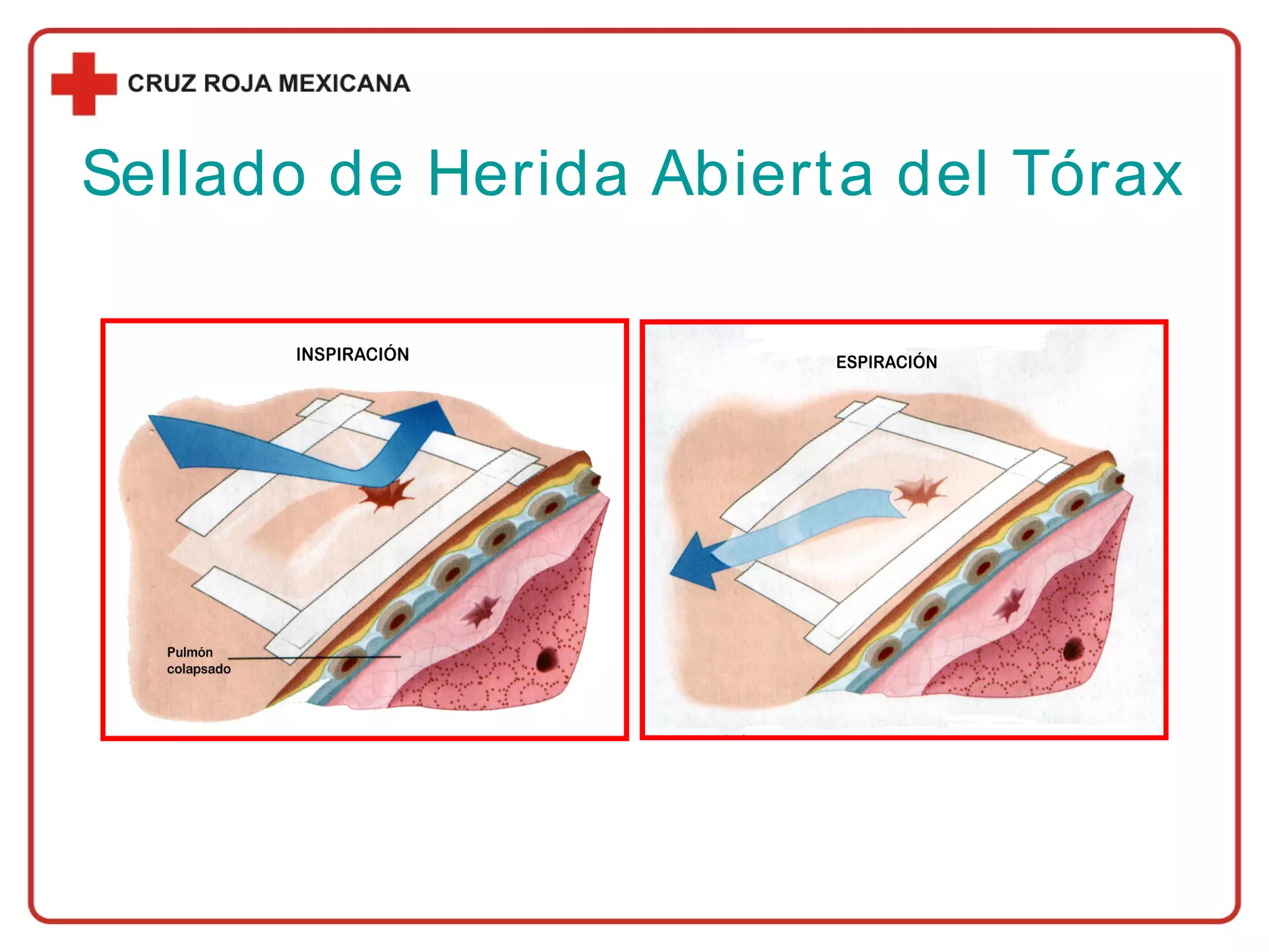 CapíTulo 21 Lesiones De TóRax, Abdomen Y Genitales | PPT