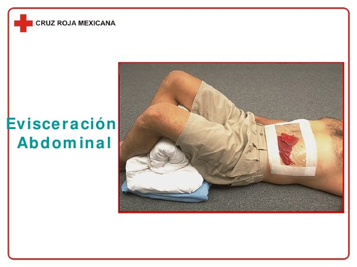 CapíTulo 21 Lesiones De TóRax, Abdomen Y Genitales