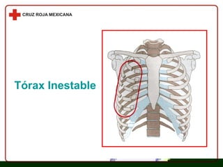 Capítulo 21 Lesiones De Tórax, Abdomen Y Genitales | PPT