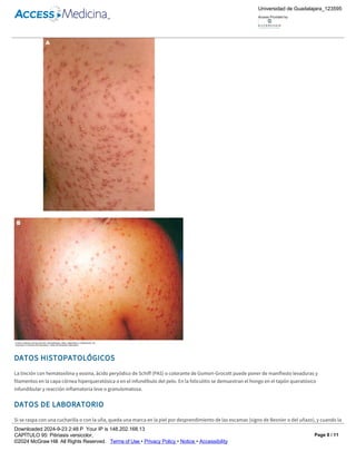 Pitiriasis versicolor arenas guzman libro de dermatologia clinica | PDF