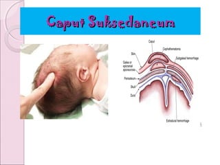 Caput Succedaneum materi askeb STIKES Muhammadiyah Kudus | PPT