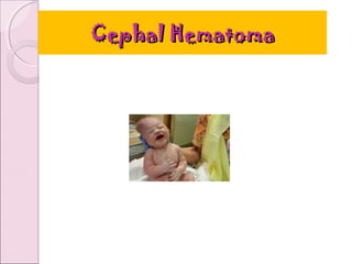 Caput Succedaneum materi askeb STIKES Muhammadiyah Kudus | PPT