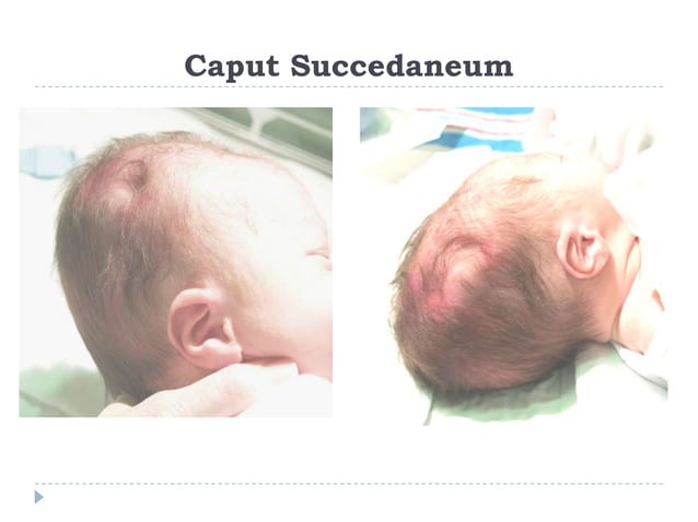 Caput Sucedaneum ppt | PPTX