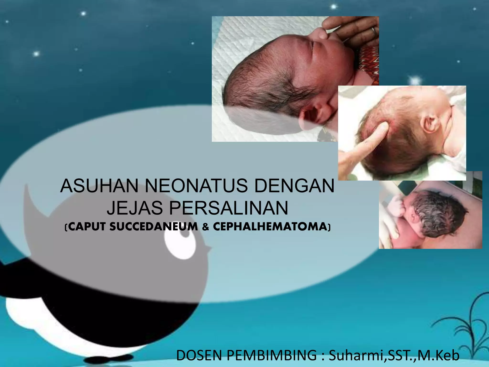 Caput succedaneum dan cephalhematoma | PPTX