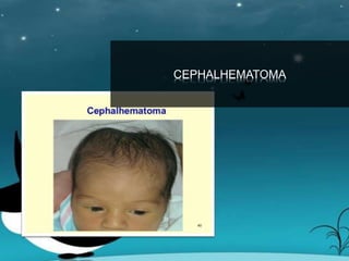 Caput succedaneum dan cephalhematoma | PPTX
