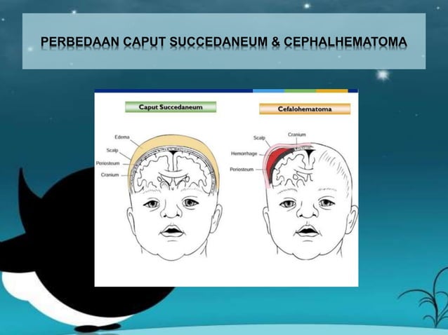 Caput succedaneum dan cephalhematoma | PPTX