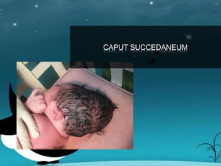 Caput succedaneum dan cephalhematoma | PPTX