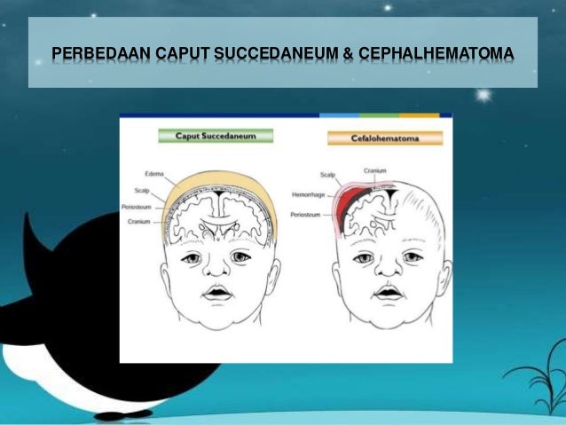 Caput succedaneum dan cephalhematoma