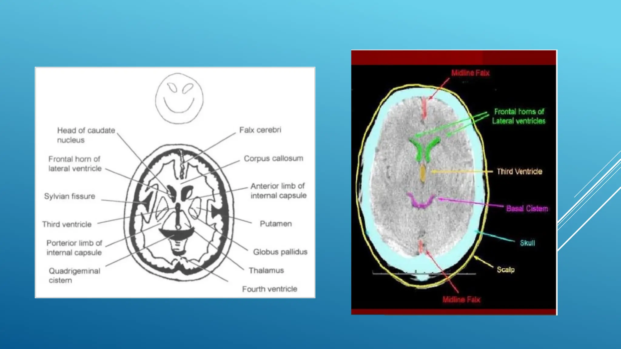 -Cara-Membaca-Ct-scan-Kepala terbaik.pptx