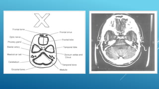 -Cara-Membaca-Ct-scan-Kepala terbaik.pptx