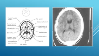 -Cara-Membaca-Ct-scan-Kepala terbaik.pptx