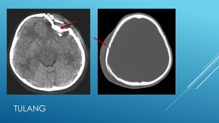 -Cara-Membaca-Ct-scan-Kepala terbaik.pptx