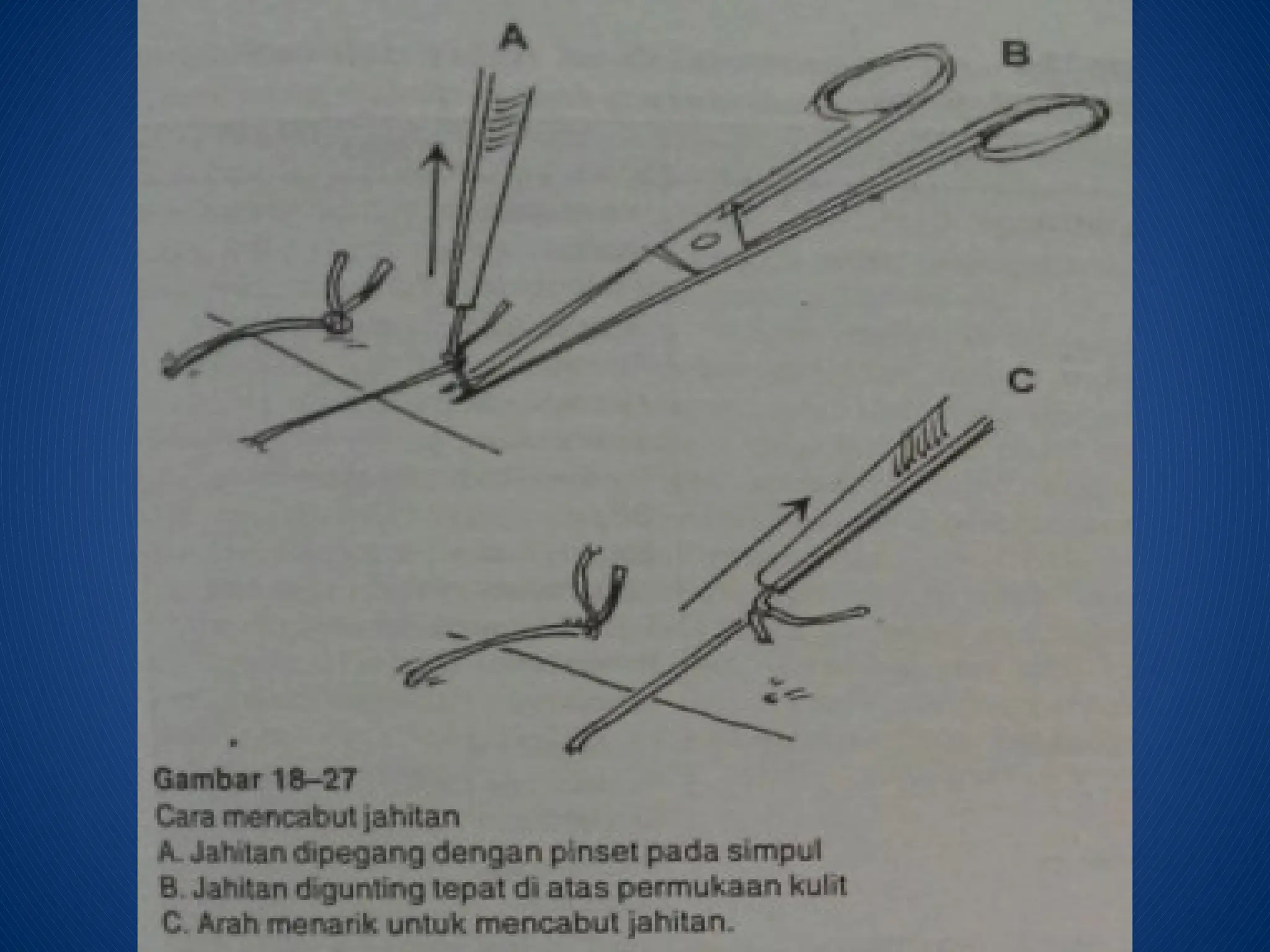 Cara-menjahit-luka-jenis-benang-dan-jarum-jahit.pptx